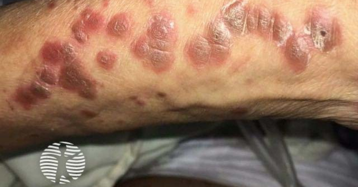 DermNet® - Secondary syphilis image