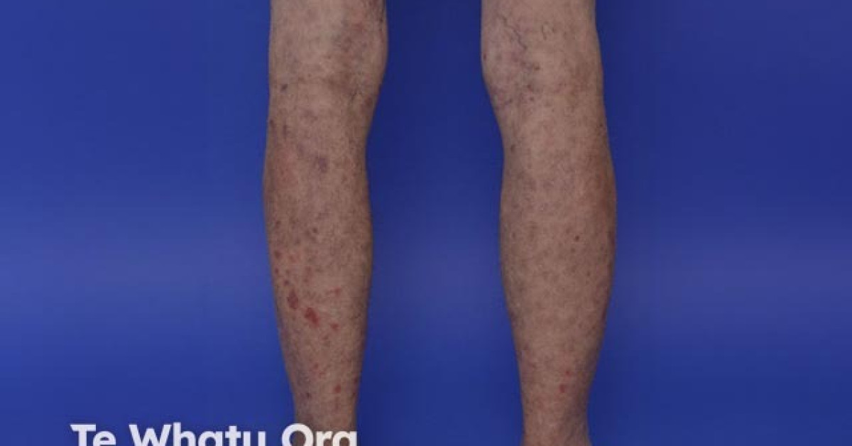 Secondary syphilis image