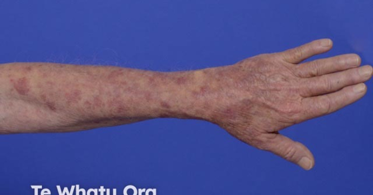 Secondary syphilis image