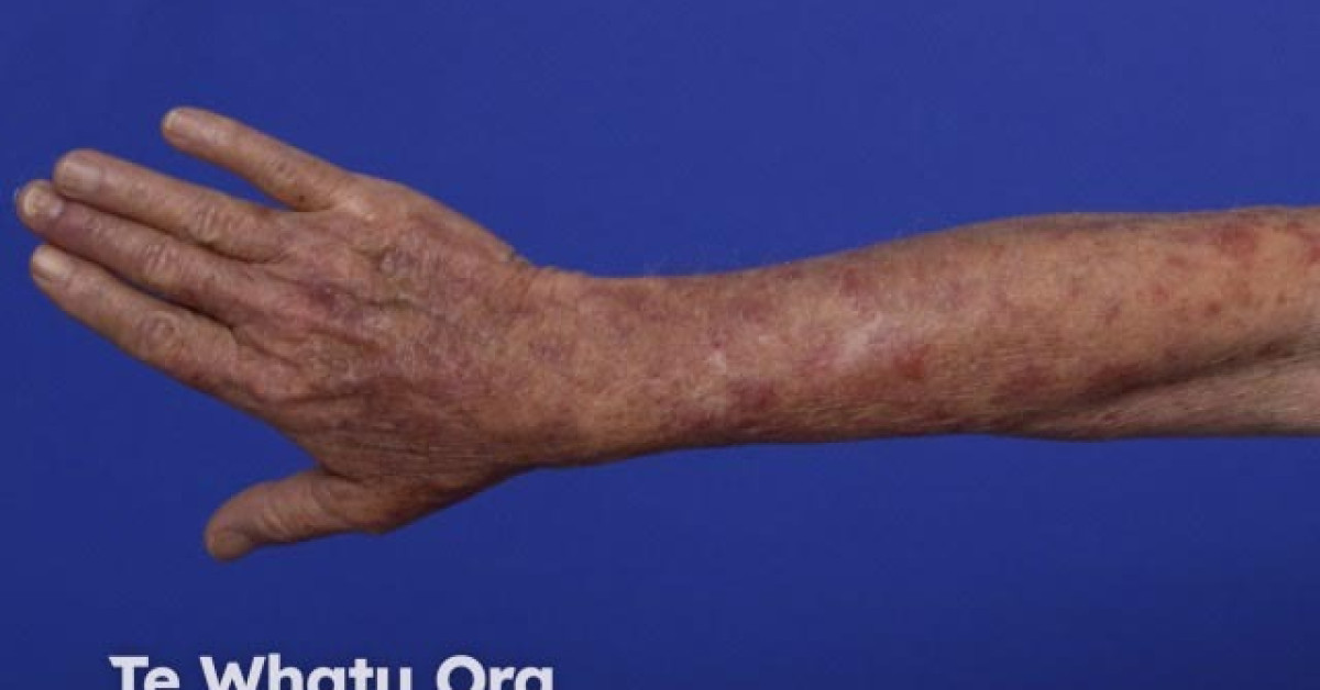 Secondary syphilis image