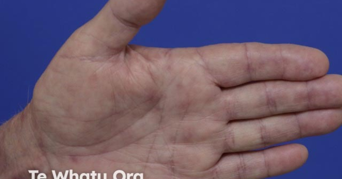 Secondary syphilis image