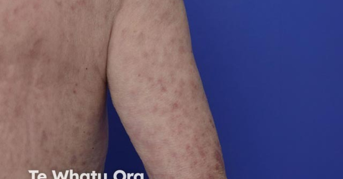 Secondary Syphilis Image