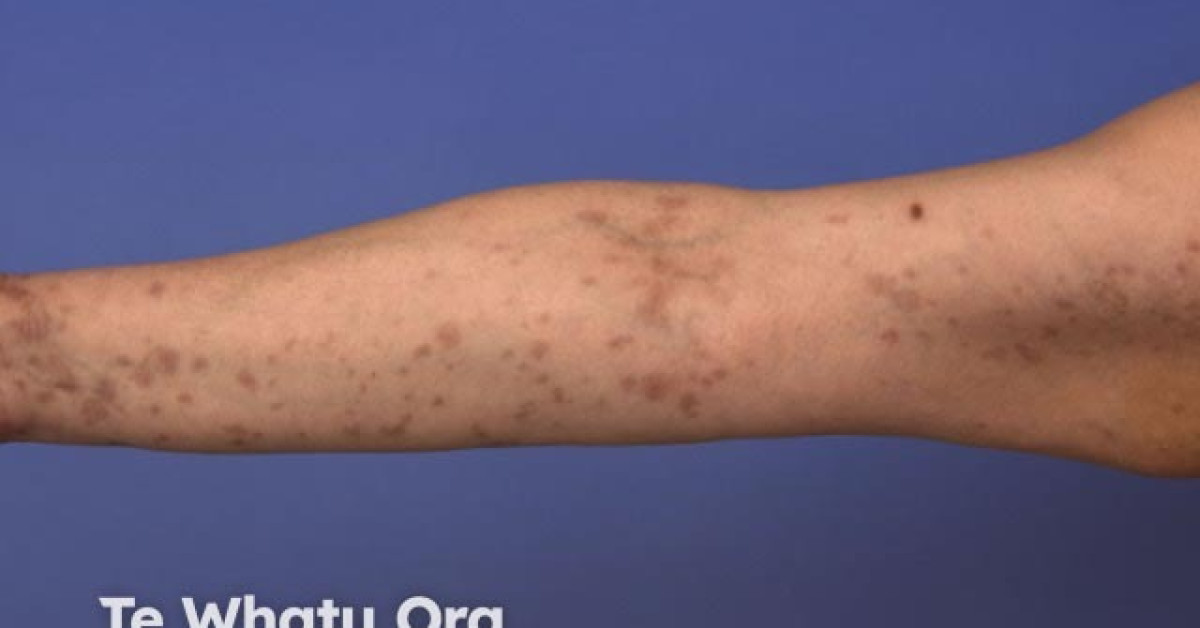 RASH image
