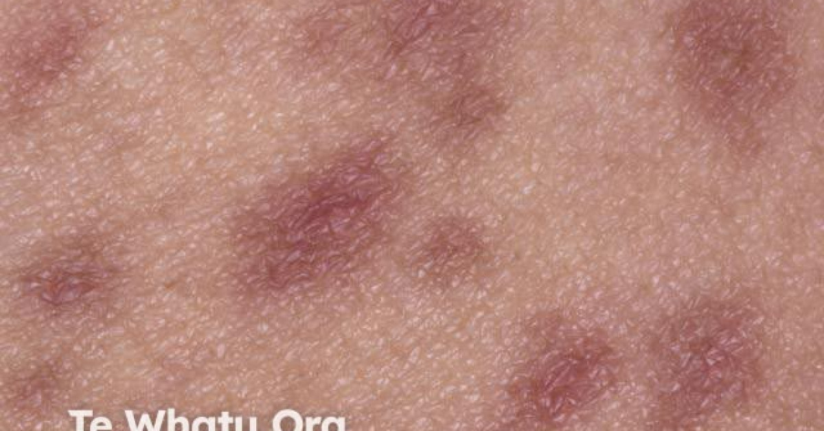 RASH image