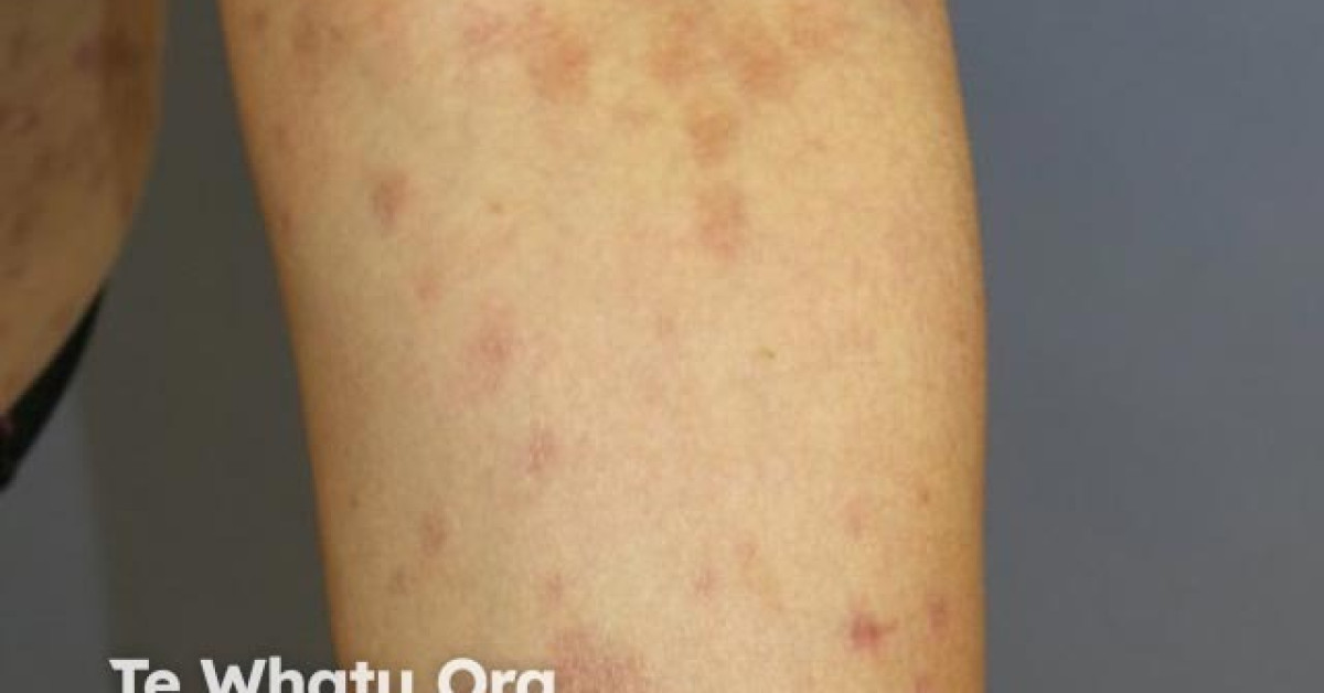 Secondary syphilis image