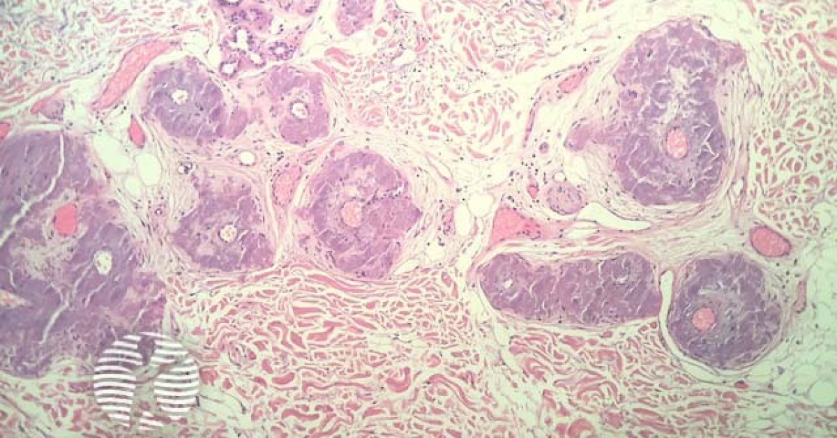 Systemic amyloidosis image