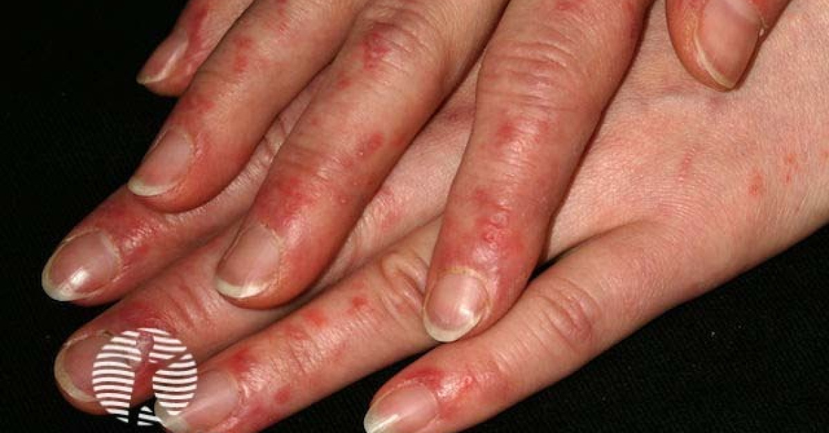 Systemic lupus erythematosus image