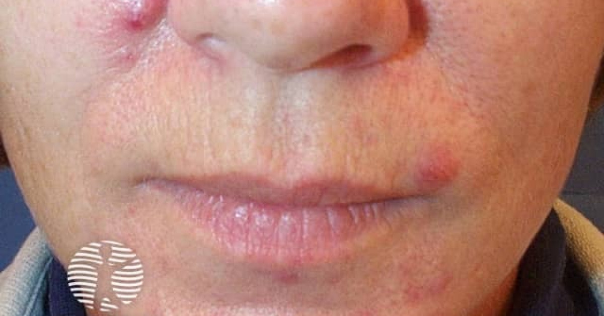 Polycystic ovarian syndrome image