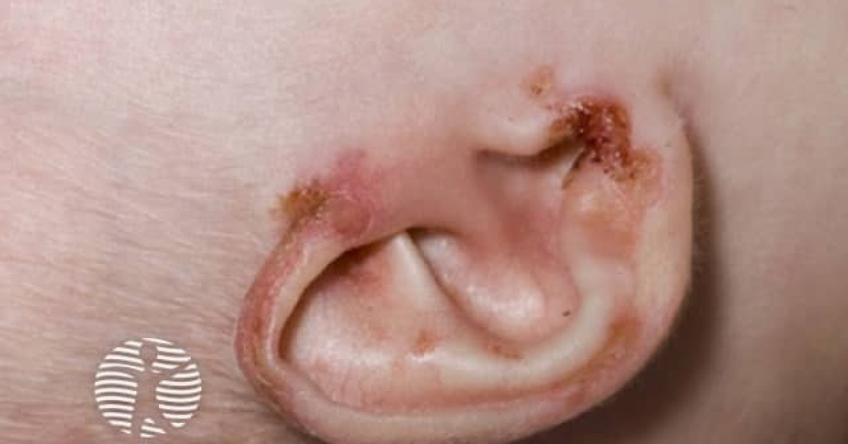 Acrodermatitis enteropathica image