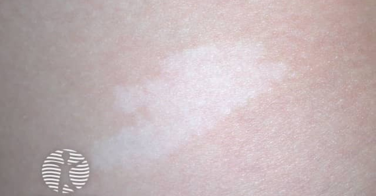 Ash leaf marks in tuberous sclerosis image