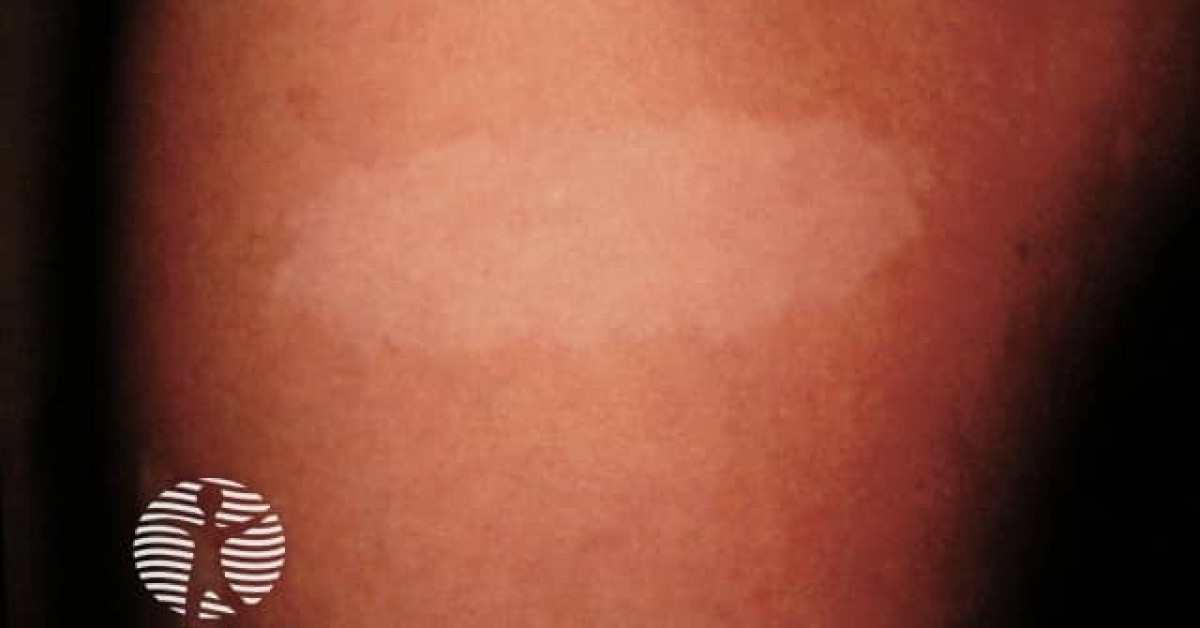 Ash leaf marks in tuberous sclerosis image