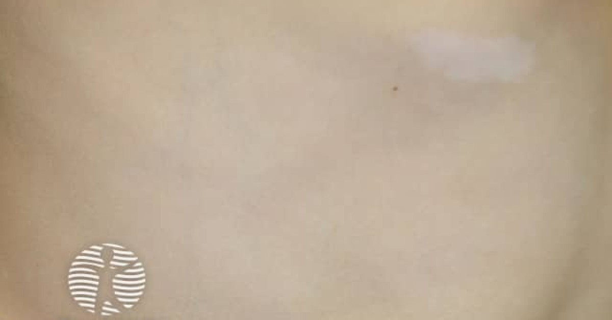 Ash leaf marks in tuberous sclerosis image