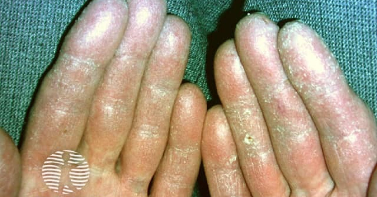Acrokeratosis neoplastica image