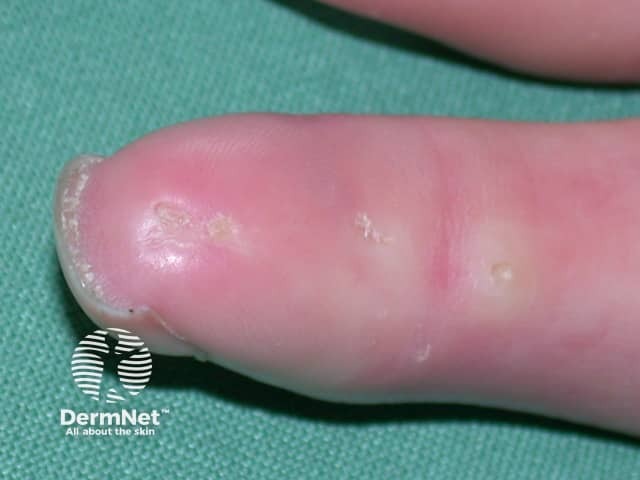 Calcinosis Cutis DermNet Calcinosis Cutis DermNet