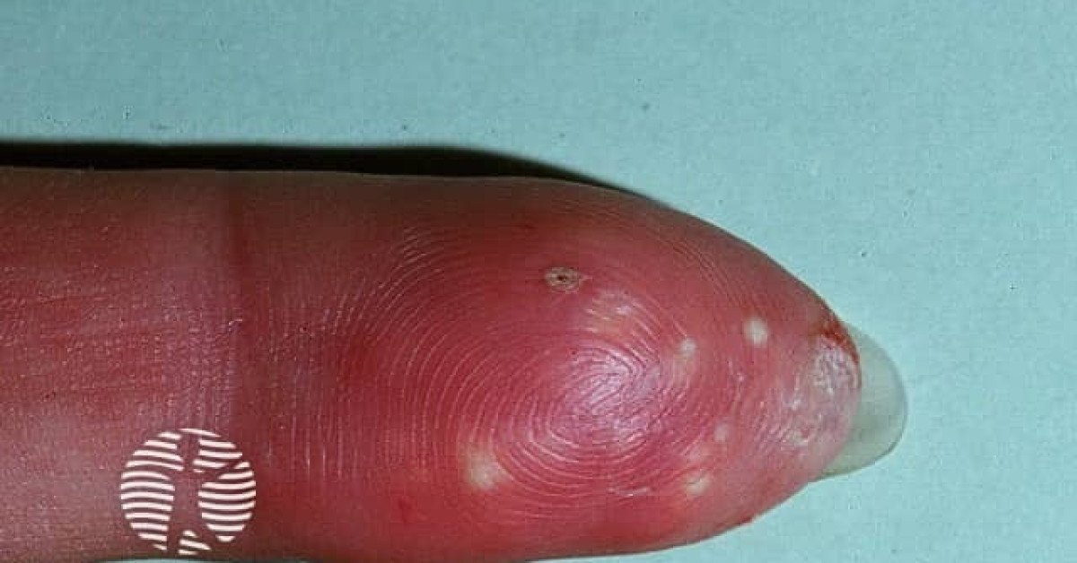 Calcinosis cutis image