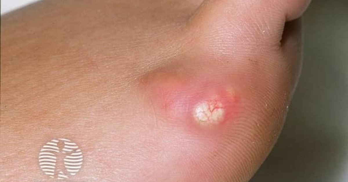 Calcinosis cutis image