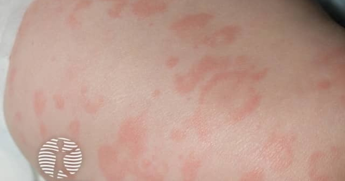 Cryopyrin-associated periodic syndrome rash image