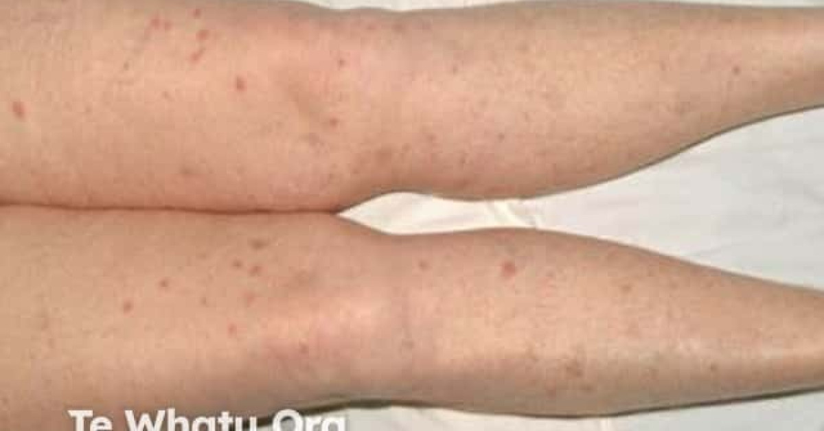 Cutaneous nodules due to Crohn disease, New Zealand Medical Journal ...