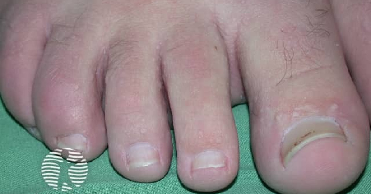 Cowden disease image