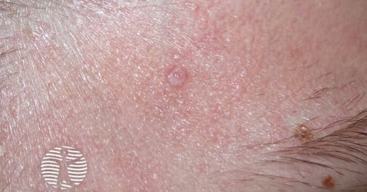 Cowden disease image