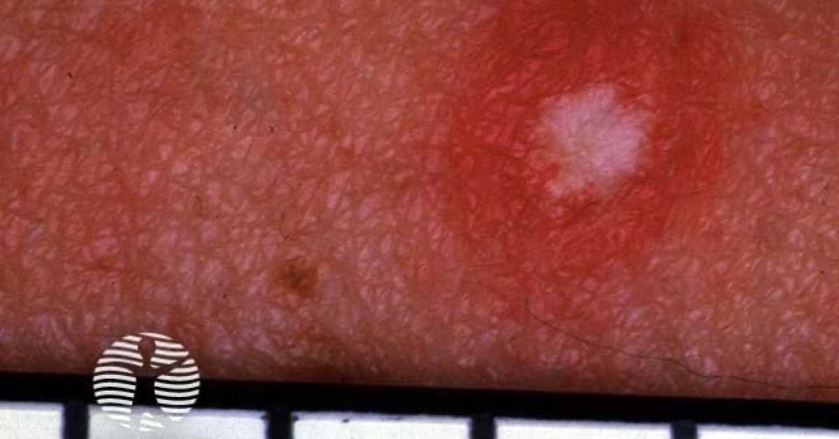 Malignant atrophic papulosis image