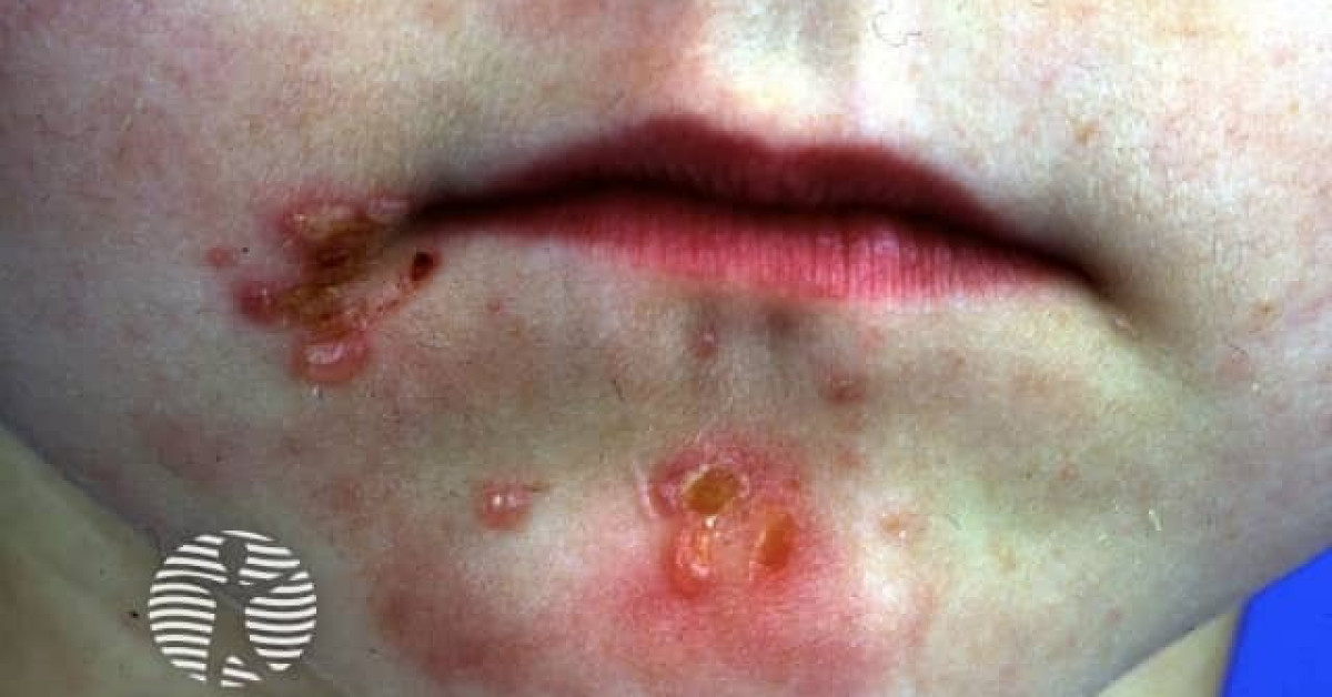 Epidermolysis bullosa image