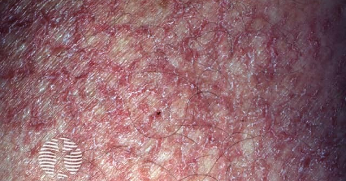 Eczema craquele image