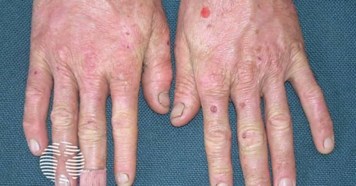 Erythropoietic protoporphyria image