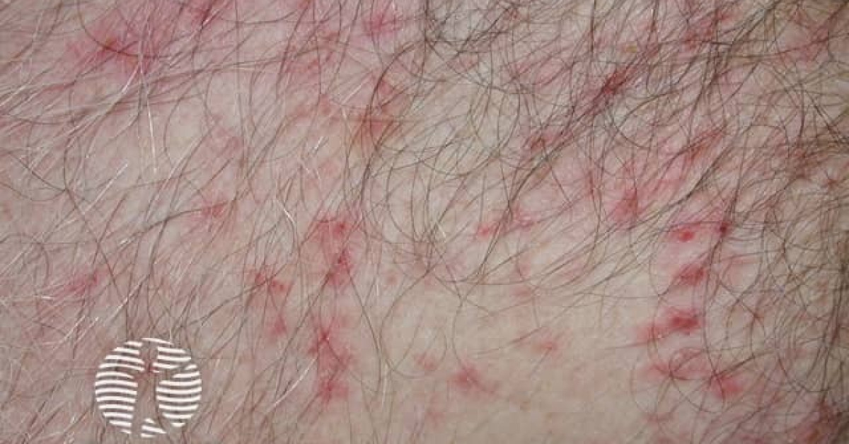 excoriations image