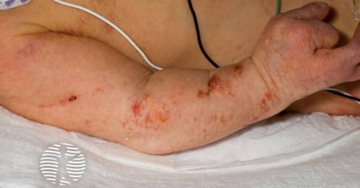 Focal dermal hypoplasia (Goltz syndrome) image