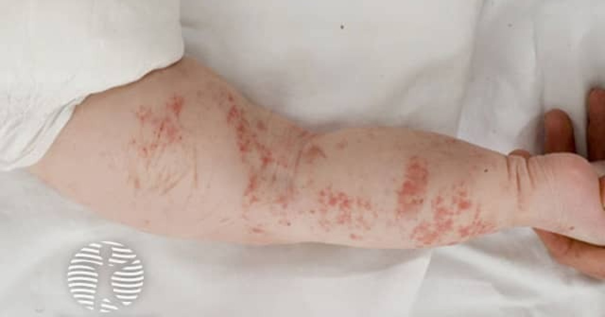 Focal dermal hypoplasia (Goltz syndrome) image