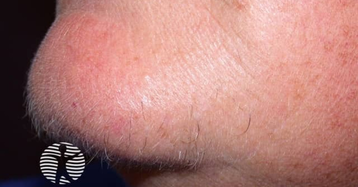 Hirsutism image