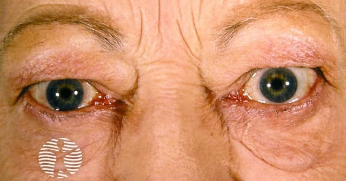 Thyroid ophthalmopathy image