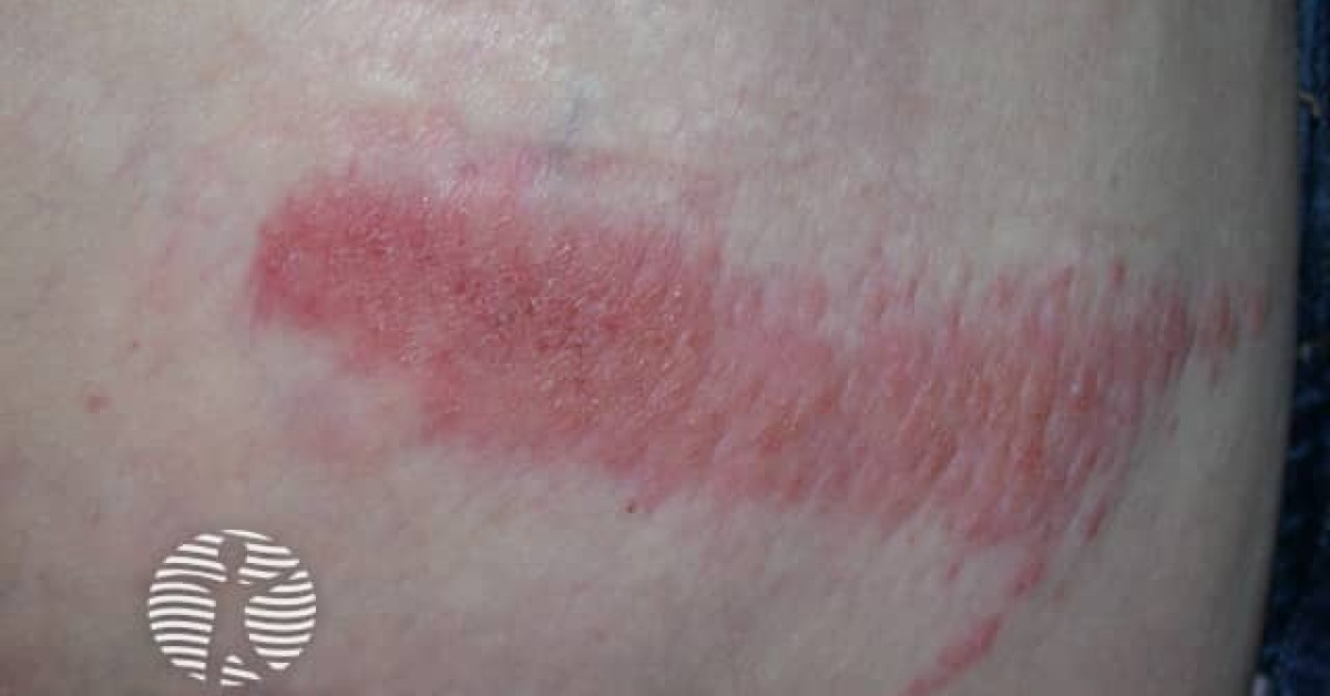 Contact Dermatitis Image