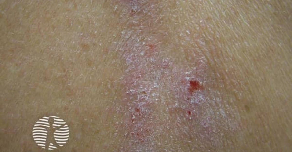 Lichen planus image