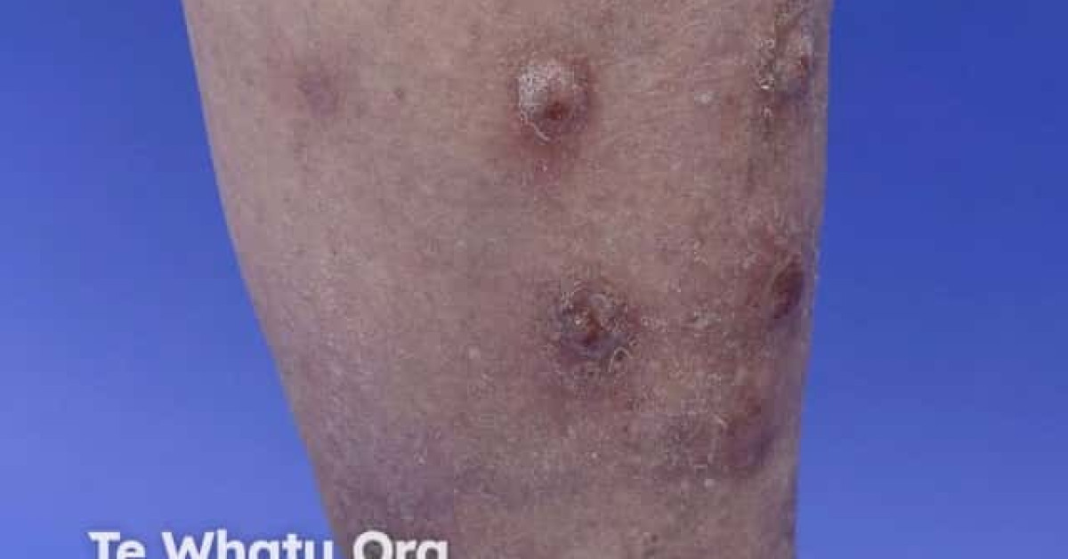 Nodular prurigo image