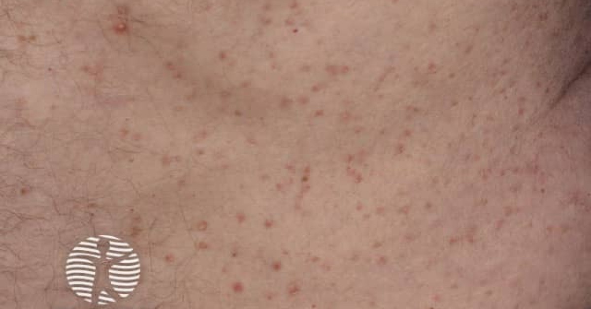Transient acantholytic dermatosis image