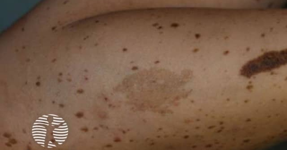 LEOPARD syndrome image