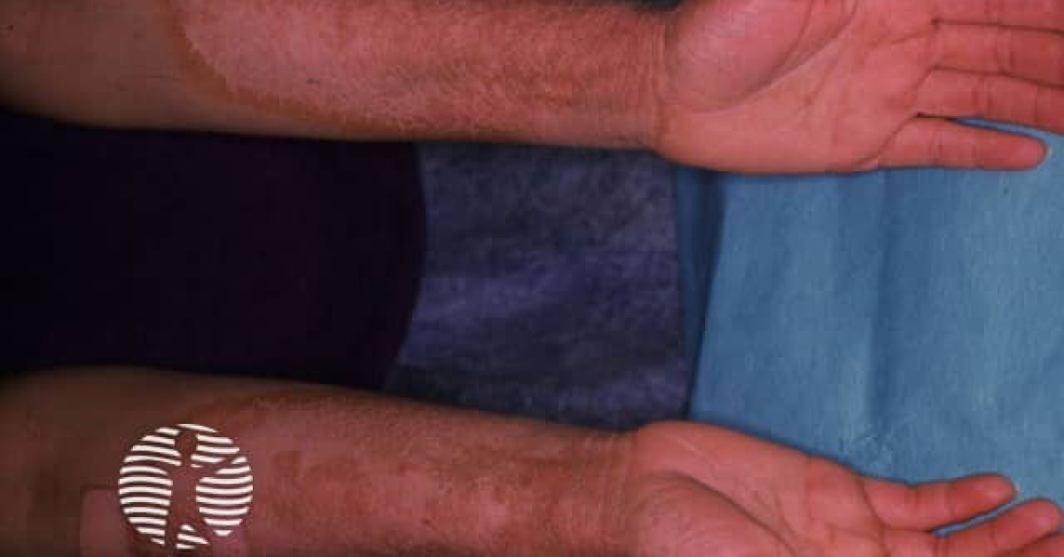 Pellagra image