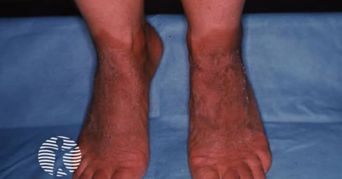 Pellagra image