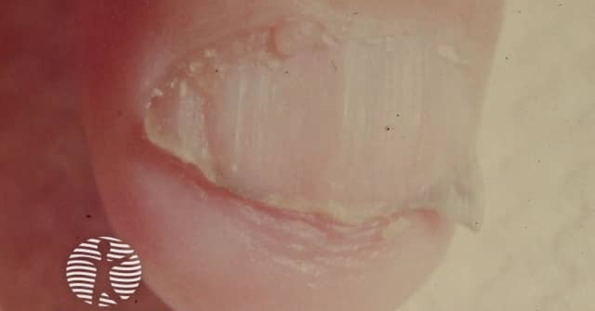 Periungual fibroma in tuberous sclerosis image