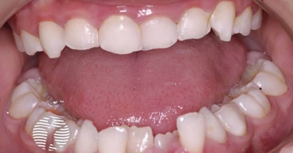 Rothmund-Thomson syndrome image