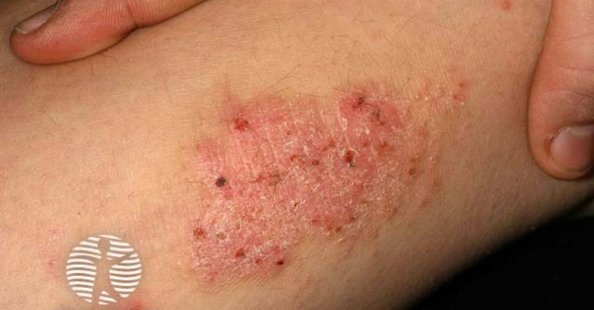 Neurodermatitis image