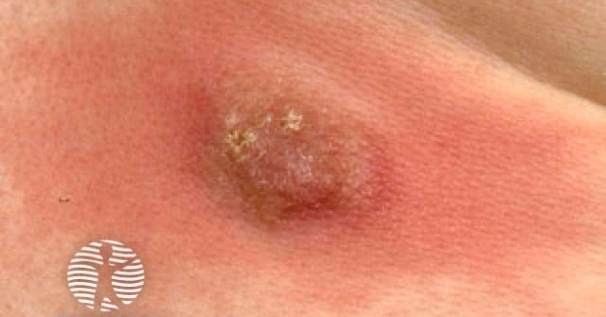 Mastocytoma after rubbing: Darier sign image