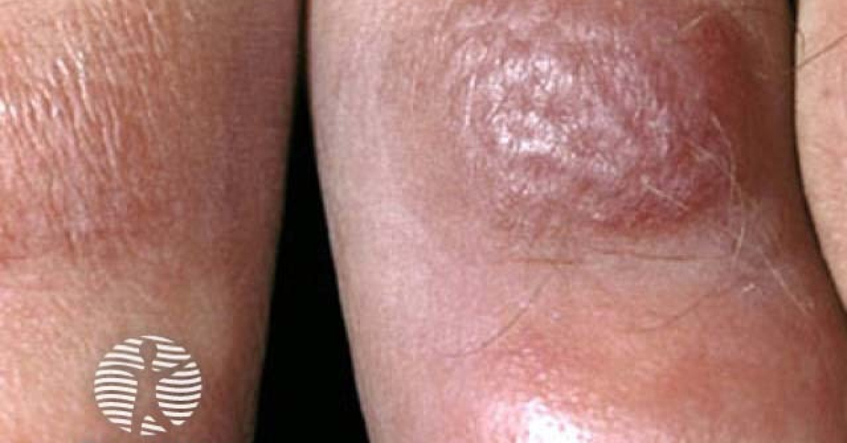 Pretibial myxoedema image