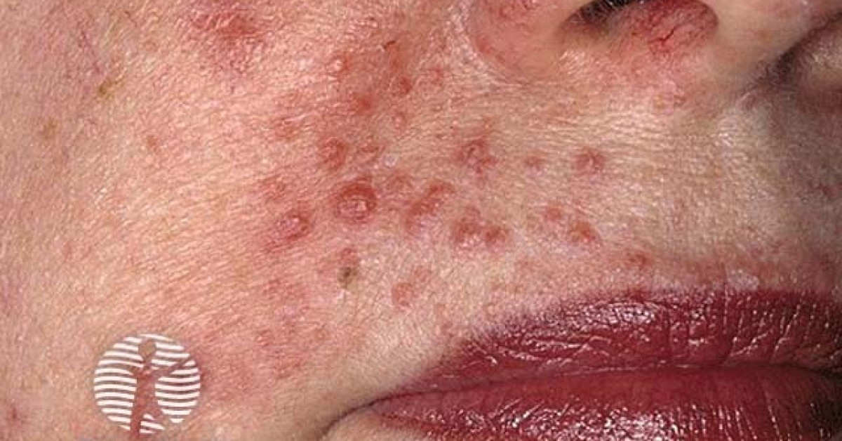 Angiofibromas in tuberous sclerosis image