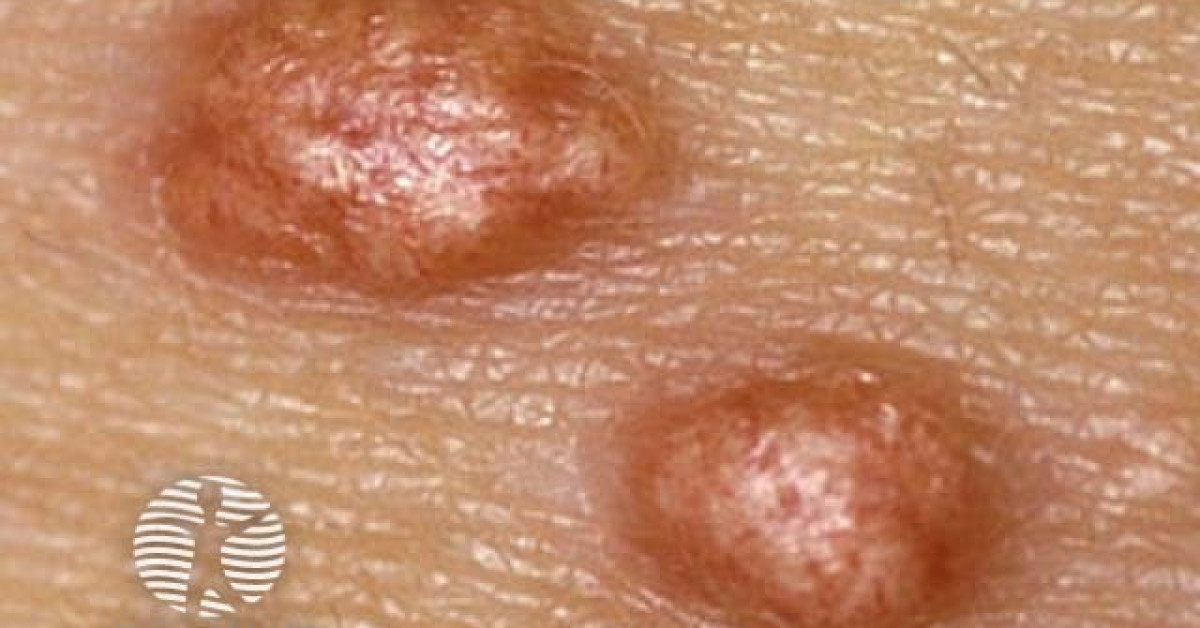 Eruptive xanthomas image