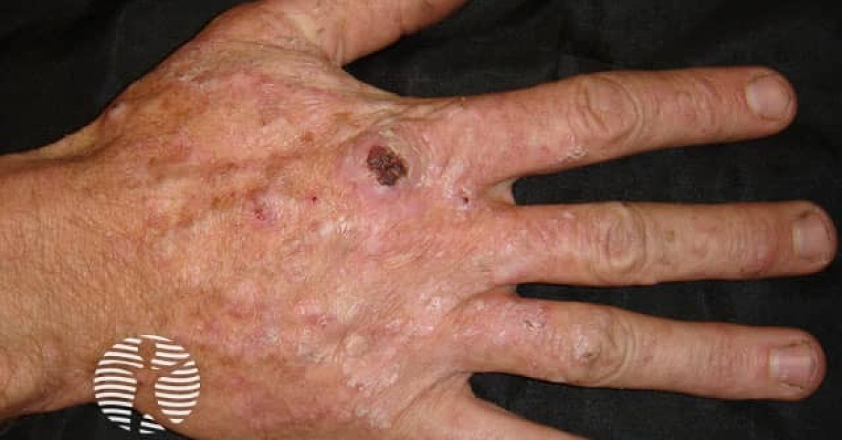 Squamous cell Carcinoma image
