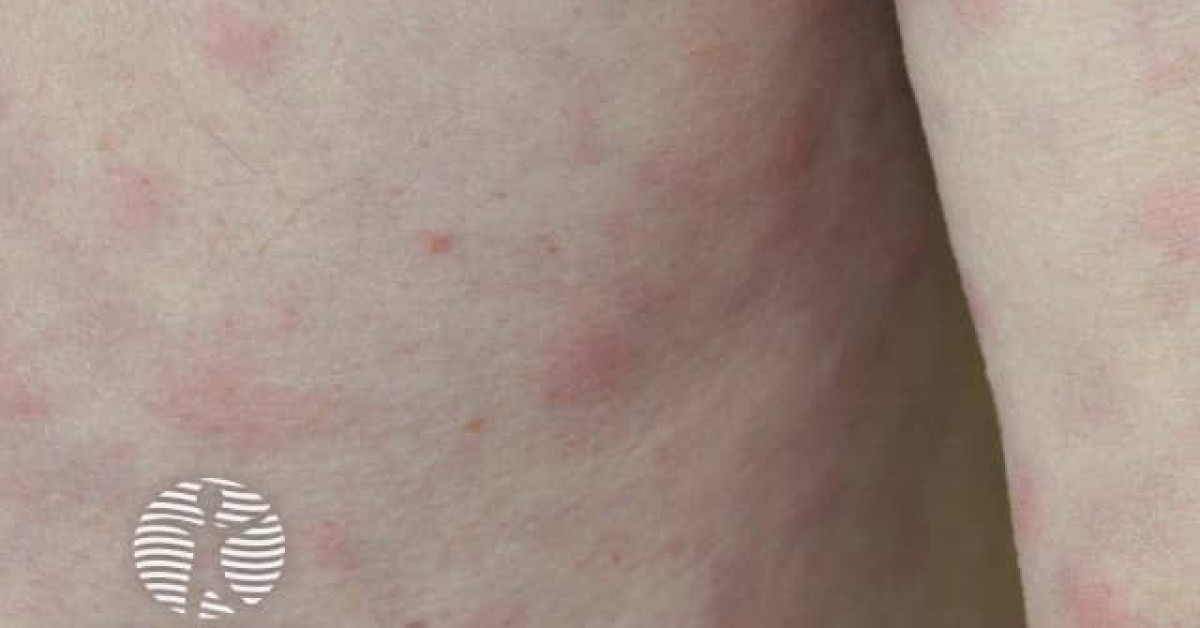 Schnitzler syndrome image