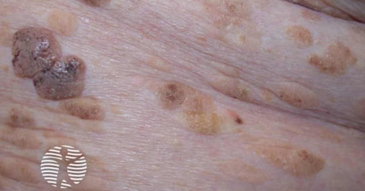 Seborrhoeic keratoses image